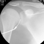 My Rotator Cuff MRI Shoulder Scan and Arthrogram (MRA)